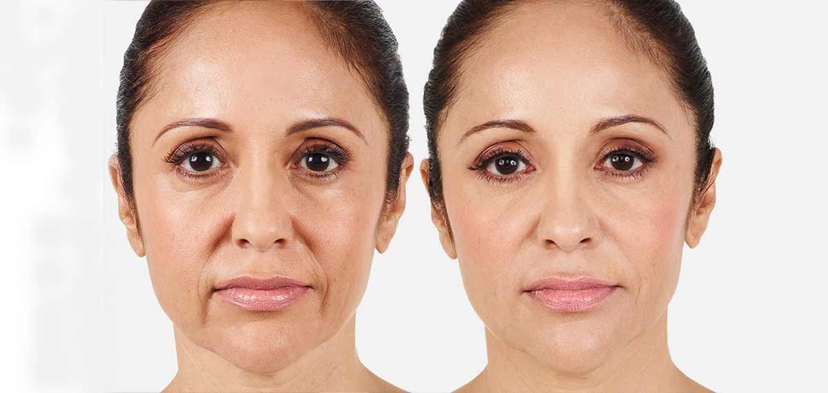 Qu’est-ce qui fait que les joues tombent et s’affaissent?